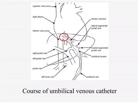 Neonatal Umbilical Venous Catherization Radiology Ppt