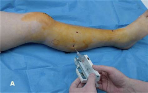 Compartment Syndrome Flashcards Quizlet