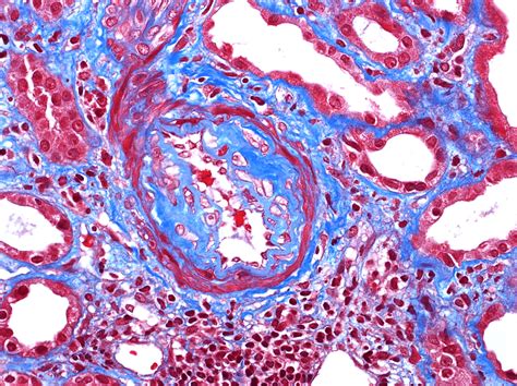 High Resolution Histopathological Imaging Of Renal Biopsy Specimen