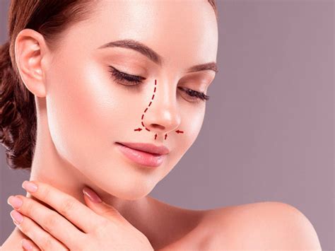 Rinoplastia Saiba Tudo Sobre A Cirurgia De Nariz Dream Plastic