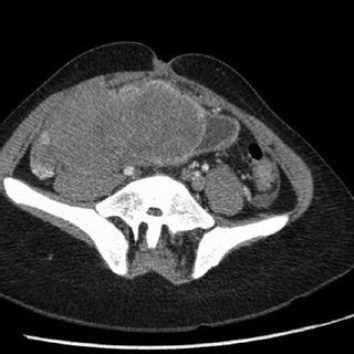 Computed Tomography Scan Of Abdomen And Pelvis Obtained At The Initial