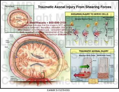 Traumatic Axonal Injury From Shearing Forces Medivisuals