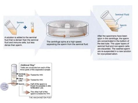 Sperm Cryoperservation