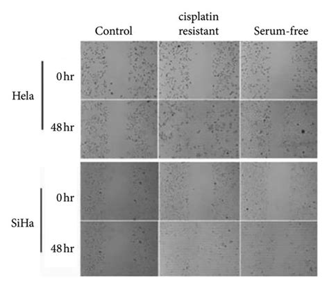 Cervical Cancer Stem Like Cells Hold Superior Migration And Invasion
