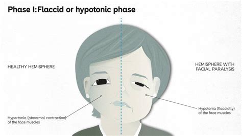 Evolution Of Facial Paralysis PortalclÍnic