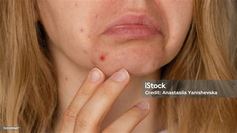 얼굴에 여드름을 보여주는 인식 할 수없는 여성 발진 피부 흉터 및 화장품에 알레르기가있는 반점이있는 여성의 얼굴에 클로즈업 여드름 문제 스킨 케어 및 건강 개념 캔디드에