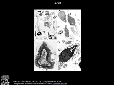 Ultrastructural Findings In Semen Samples Of Infertile Men Infected With Chlamydia Trachomatis