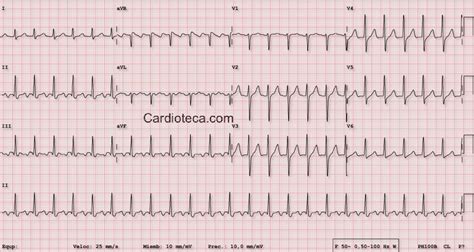 Flutter Atrial Flutter Auricular Images
