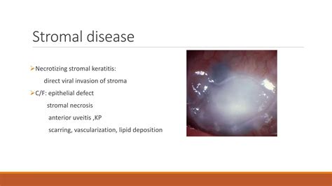 Viral Keratitis Pathogenesis Pptx Eye And Vision Conditions Diseases And Conditions