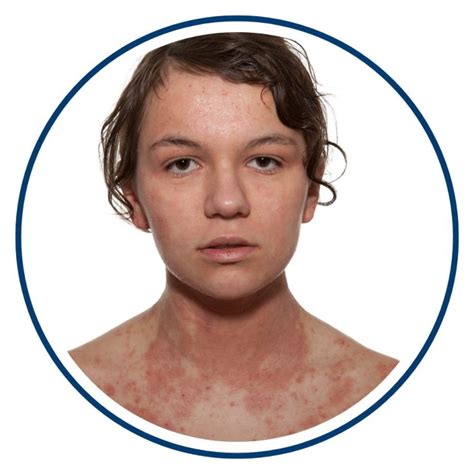 What Is Eczema Eczema Association Of Australasia
