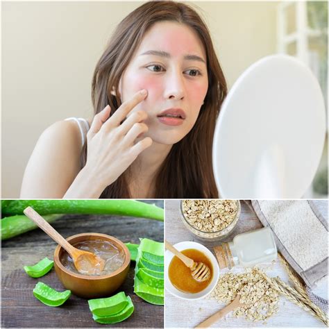 Home Remedies For Sunburn Soothe And Heal Your Skin