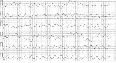 Hyperkalemia Ecg Sine Wave