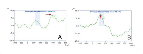 Aided Cortical Assessment Uses In A Paediatric Hearing Implant Centre Ent And Audiology News