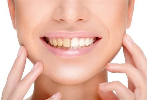 Benefits To Post Braces Tooth Whitening Orthodontic Associates