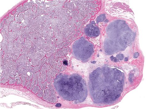 Cartilage Forming Tumors Clinical Tree