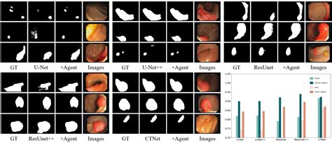 Agentpolyp Accurate Polyp Segmentation Via Image Enhancement Agent Ai Research Paper Details