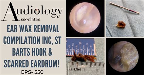 Ear Wax Removal Compilation With St Barts Hook And Scarred Eardrum