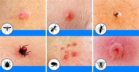 Insect Bites And Stings Insect Bites Treatment How To Treat Insect Bites And Stings 2018
