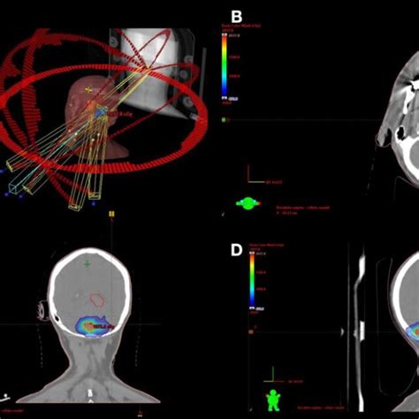 Planning Example Of A Patient With Three Brain Metastases Treated With