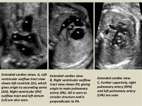 Presentation1 Pptx Ultrasound Examination Of The 2nd And 3rd Trimester…