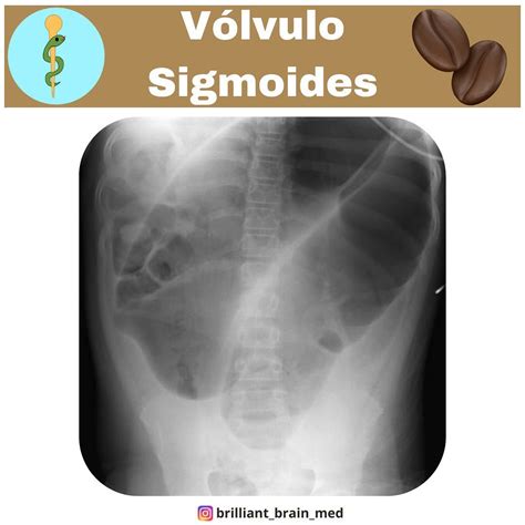 Brilliant Brain Med 🧠 Signo De Cullen Se Caracteriza Por Una