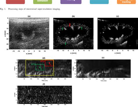 Figure 10 From Improved Super Resolution Ultrasound Microvessel Imaging