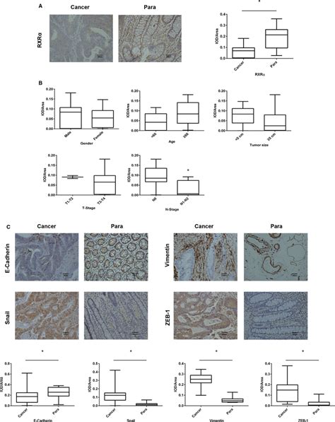 Rxrα‐ And Emt‐related Proteins Expression In Cancer And Para‐carcinoma