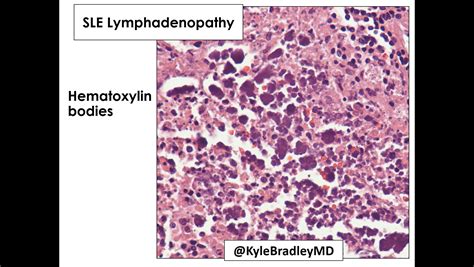 Reactive Lymph Nodes Lecture Part 2 Of 2 Capvirtualpath Twitter