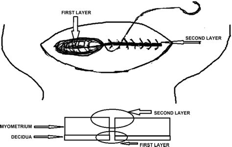 Illustration Of Double Layer Uterine Closure Technique Download