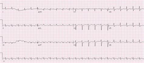 Section 12 Quiz Atrial Flutter Flashcards Quizlet