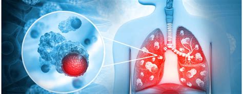 Tuberculose Saiba Como Identificar Os Sintomas Tratamento E Vacinação