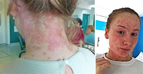 Woman Who Breaks Out In Red Hives Every Day Is Searching For A Cure