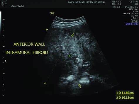 Huge Fibroids Including Intramural Fibroid Occupying The Whole Of Lower