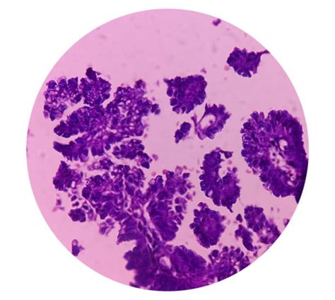 40 Papillary Adenocarcinoma Foto Stok Potret And Gambar Bebas Royalti