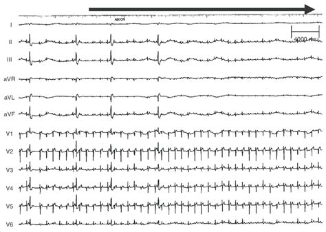 Surface 12 Lead Ecg During The Successful Radiofrequency Energy
