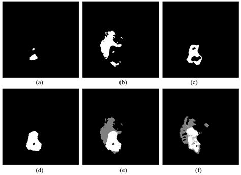 An Example Of Tumor Growth Model By Using Proposed Method For One Slice
