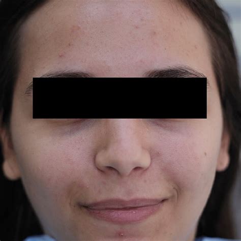 Clinical Aspect Of The Face Before Any Intervention Download