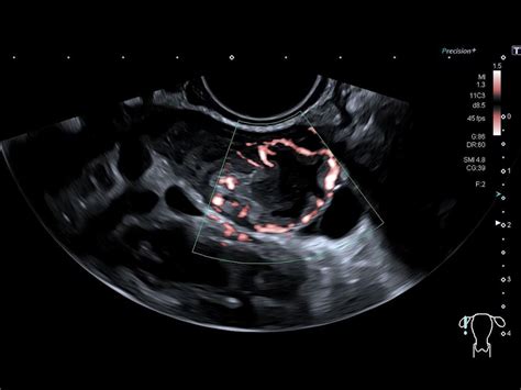 Smi Aplio I Series Clinical Gallery Ultrasound Canon Medical