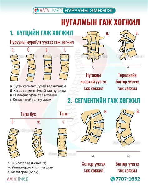 ⚕️ Багана нурууны гаж хөгжлийг эрт Алтанмед эмнэлэг