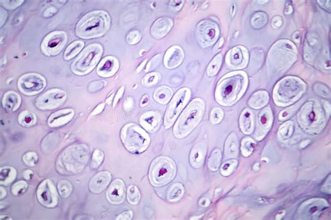 Photomicrograph Of Chondrosarcoma Showcasing The Cellular Details Of