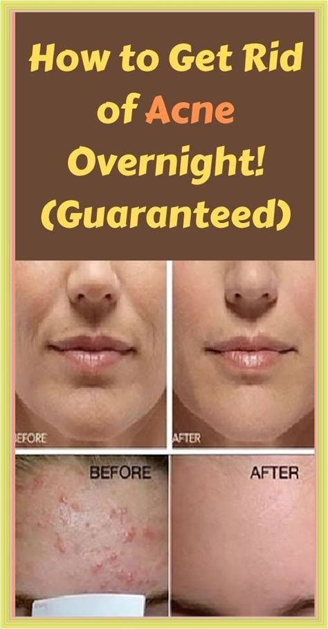 How To Get Rid Of Pimples Overnight In 2022 Acne Overnight Pimples