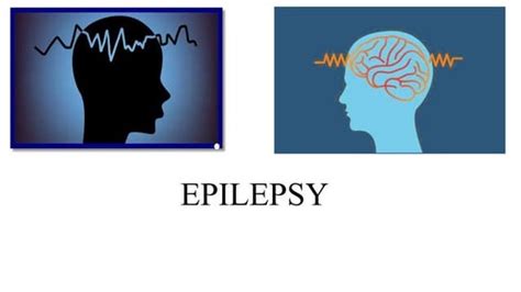 Epilepsy Ppt