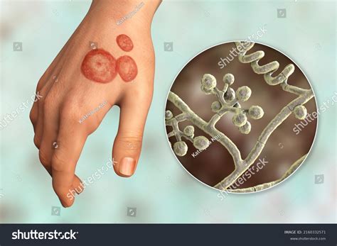 Fungal Infection On Human Hand Ringworm Stock Illustration 2160332571