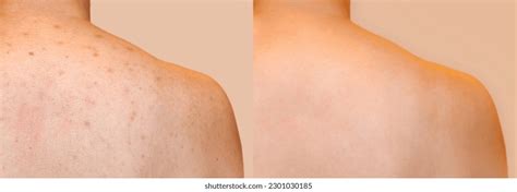 Acne Scars On Shoulders And Back