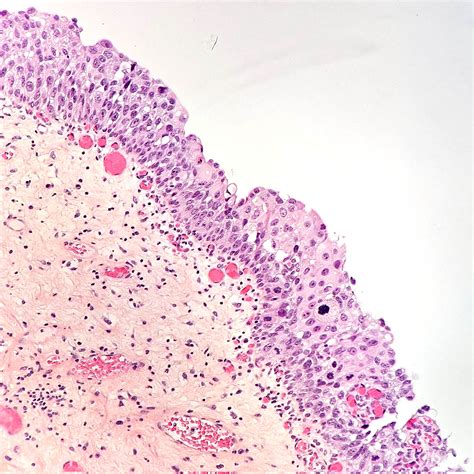 Pathology Outlines Carcinoma In Situ