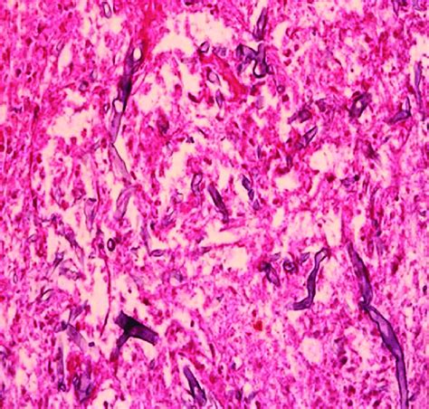 Histopathology Microphotograph Showing Broad Non Septate Hyphae With