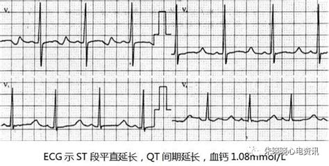 有图有真相72个导致T波及ST段异常的原因