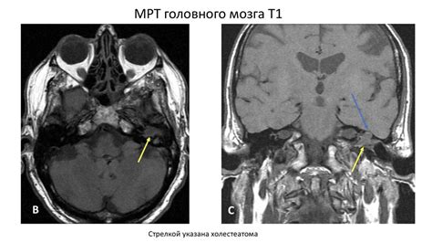 Хронический гнойный средний отит презентация онлайн