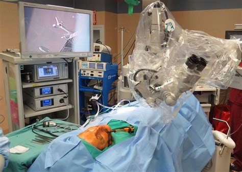 Combined Open And Endoscopic Removal Of Parotid Stone Sialendoscopy