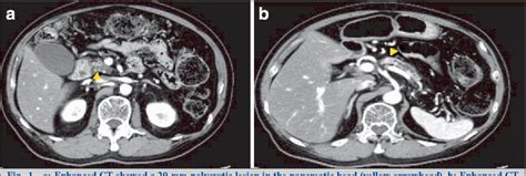 Figure 1 From Coexisting Pancreatic Ductal Adenocarcinomas Derived From